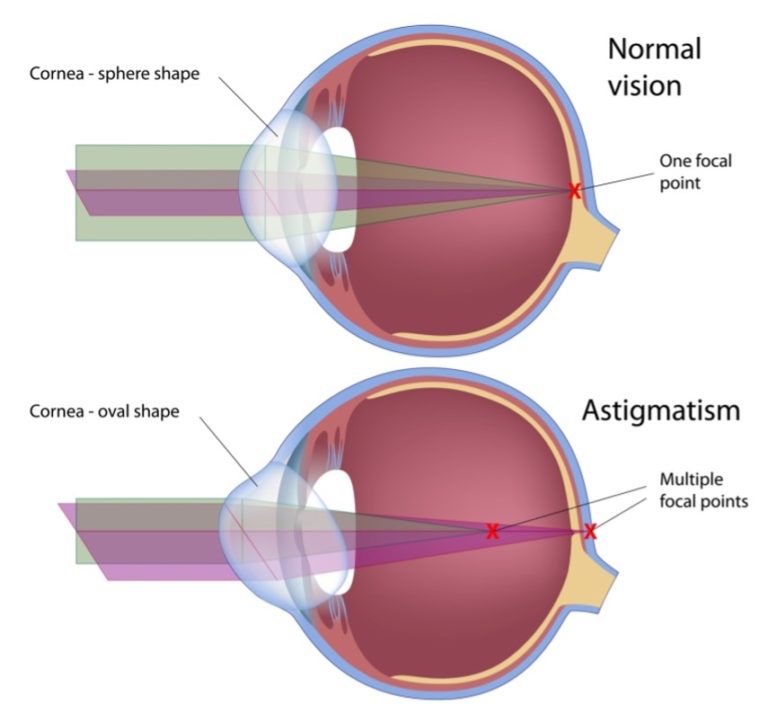 Cataract Surgery In New Jersey Flemington Nj Clinton Nj Bridgewater Nj